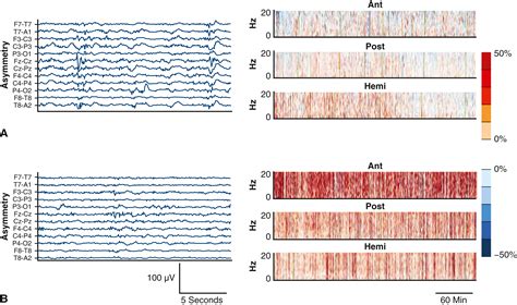 Postoperative Electroencephalographic Anterior Asymmetry Is Associated