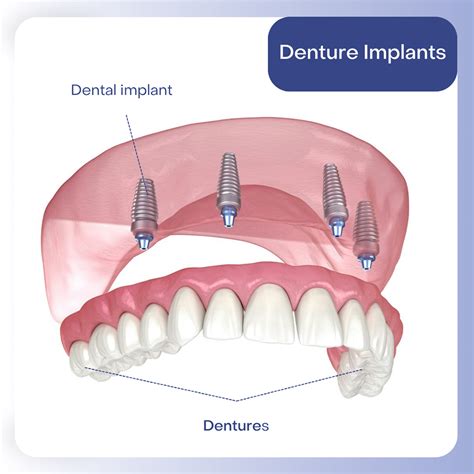 Denture Dentist Hackensack Nj Dental Dentures In Hackensack New Jersey