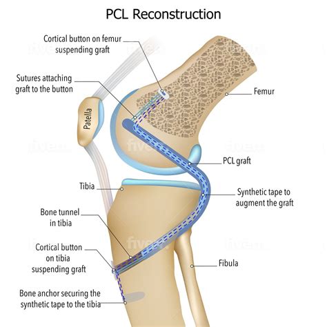 Pcl Reconstruction Posterior Cruciate Ligament