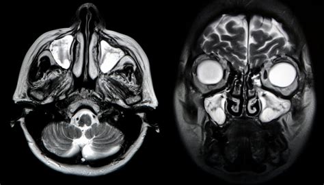 Sinusitis Respiratory System Saturn Medic