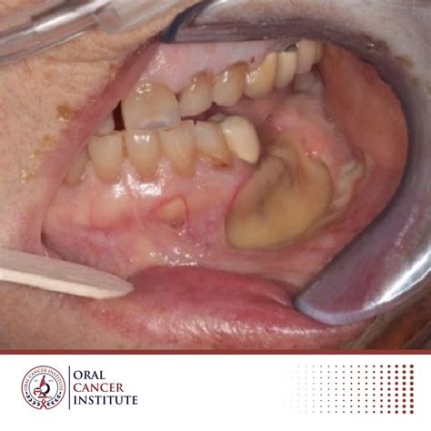 Oral Cancer Institute On Linkedin Osteomyelitis