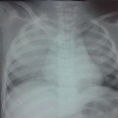 Chest X Ray Revealing Bilateral Diffuse Pulmonary Infiltrates With
