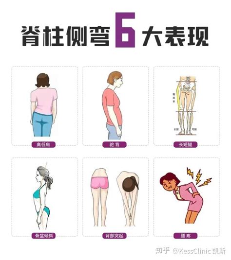 惠州凯斯骨科：青少年脊柱侧弯有什么表现？有什么影响？ 知乎