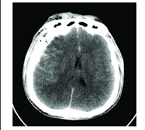 Ct Of The Head Before Decompressive Craniectomy Shows Right Subdural Download Scientific
