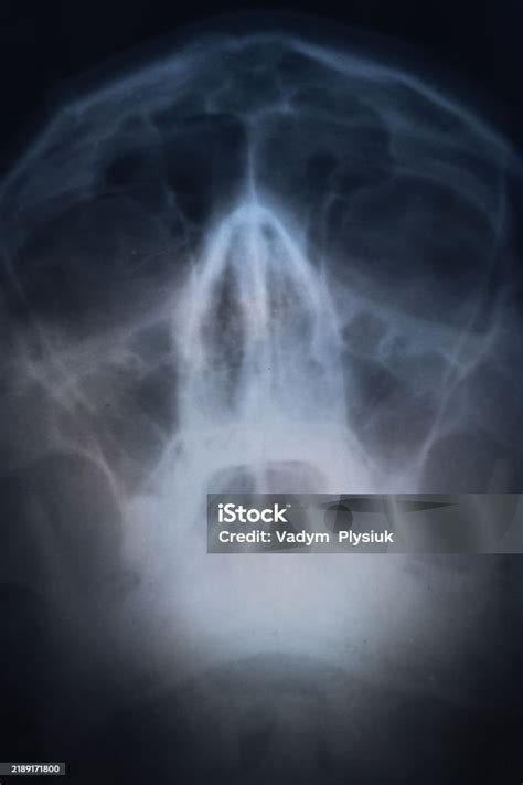 Vertical Xray Scan Of A Human Skull Deviated Septum Nasal Septum Bone And Cartilage That Divide
