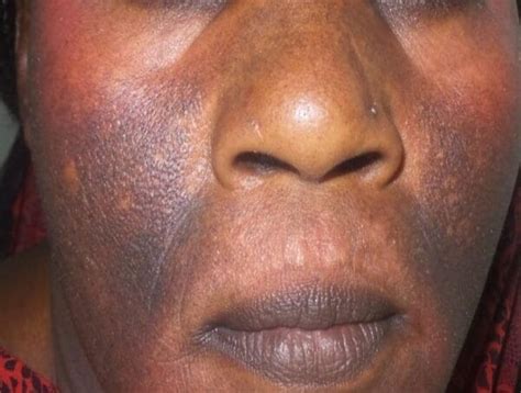 What Does Ochronosis Look Like