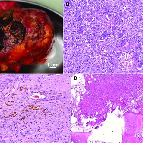 A Surgical Defect After En Bloc Subtotal Sternectomy For Gtc Tumor Of Download Scientific
