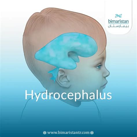 How Common Is Hydrocephalus