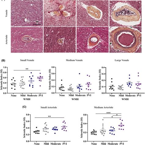 Stenosis Of Both The Small Arterioles And Venules Is Evident In The