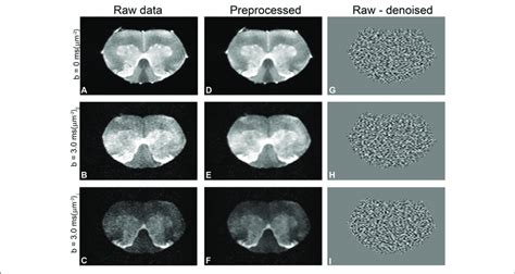 Quality Of Diffusion Mri Data And Preprocessing In A Representative Download Scientific
