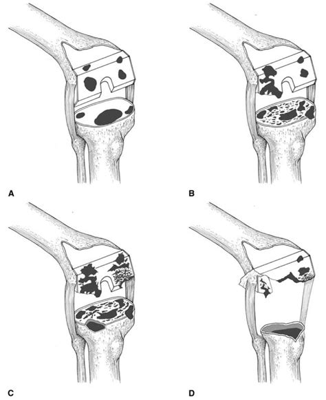Tka Revision Recon Orthobullets