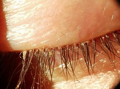 Demodex And Its Link To Blepharitis And Facial Dermatoses Opth