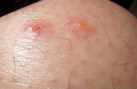 What Do Chigger Bites Look Like Photos To Help Identify And Treat Them