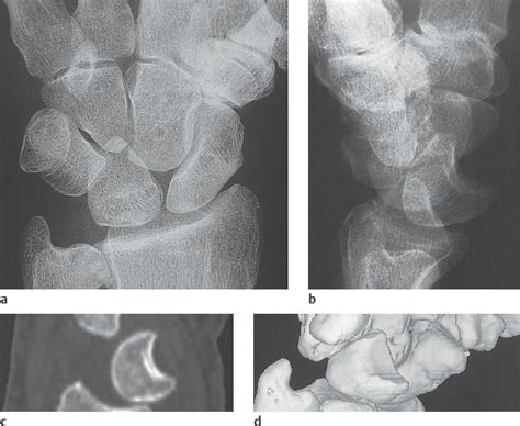 22 Carpal Dislocations And Fracture Dislocations Radiology Key
