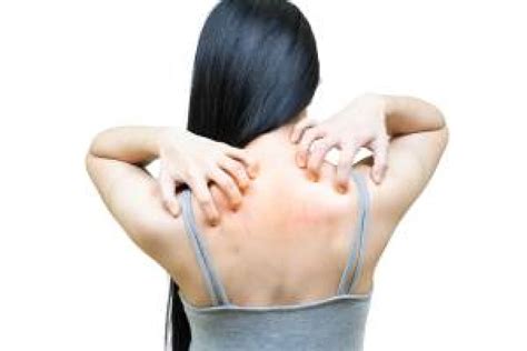 Sun Allergy Everything You Need To Know For Your Protection