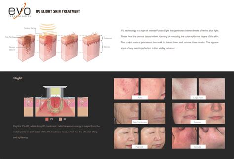 Evo Ipl Shr Evo Technologies