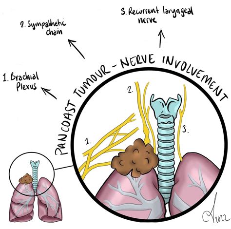 Review Management Of Pancoast Tumours Hetpf