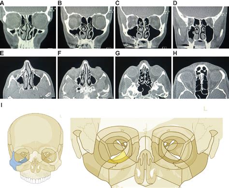 The Comprehensive Aocmf Classification System Orbital Fractures