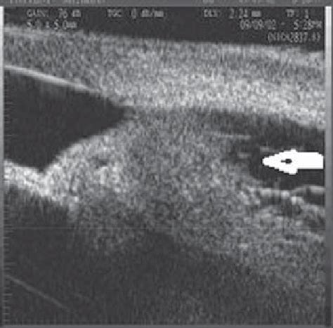 Supraciliary Effusion Suparciliary Effusion Is Noted At Fl Uid In