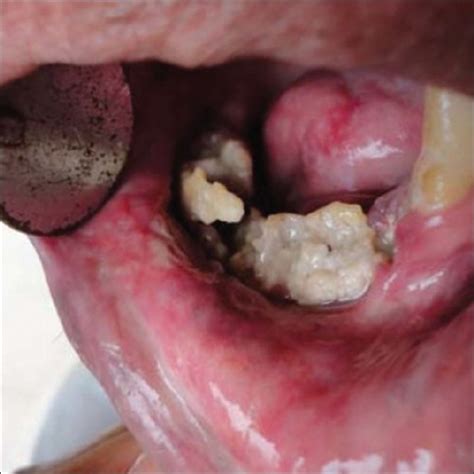 Osteoradionecrosis Of Mandible Case Report With Review Of Literature Pmc