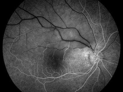 Branch Retinal Artery Occulsion — Retina Macula Institute