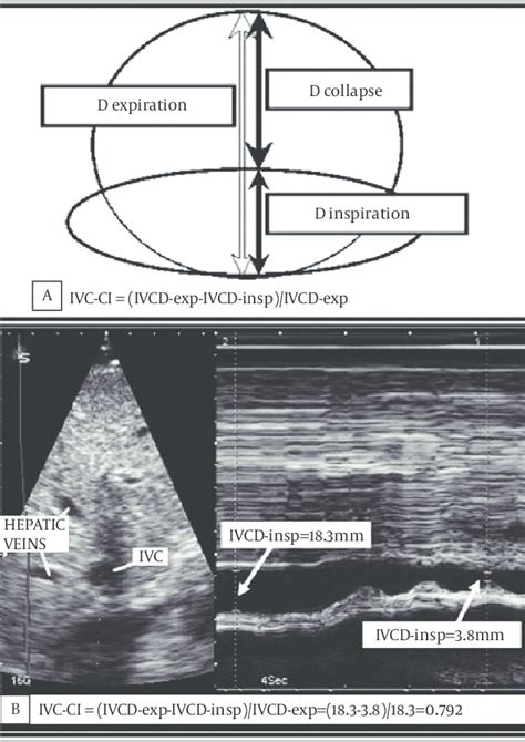 a representation of the ivc collapsibility index ivcci and b