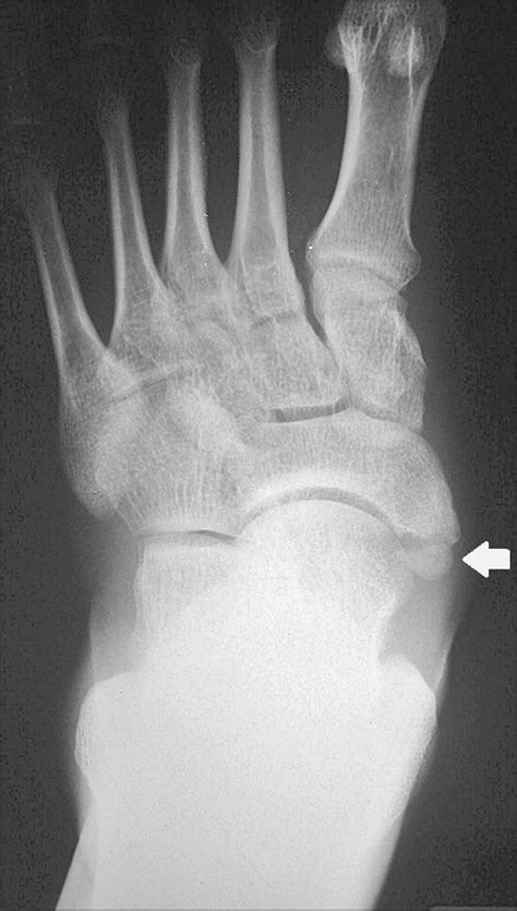 Accessory Ossicles Foot