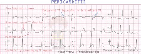 Ecg Educator Blog Pericarditis