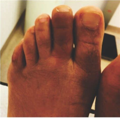 Diffuse Swelling Of The Second Right Toe Sausage Like Consistent