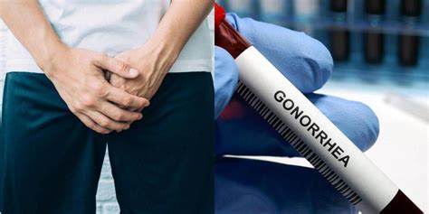 Gonorrea Estos Son Los Síntomas De La Enfermedad Y Sus Posibles
