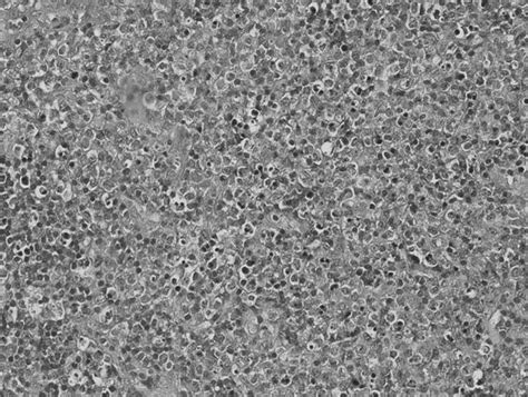Lymph Node Biopsy Shows Necrotizing Lesion Composed Of Various Download Scientific Diagram