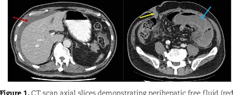 Figure 1 From A Rare Case Of Intestinal Internal Hernia Beneath The