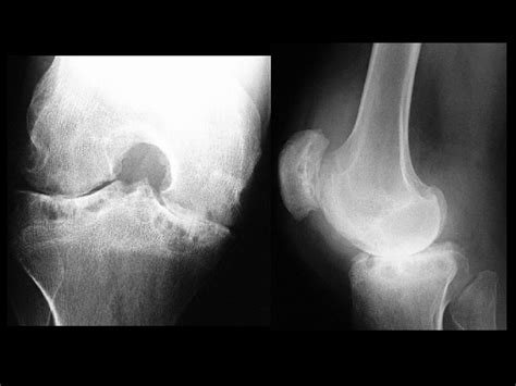 Anterior Shoulder Dislocation Findings Inferomedial Subcoracoid Displacement Of