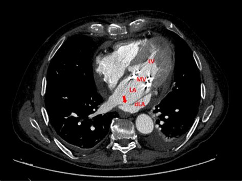 Postoperative Computed Tomography Showing A Residual Nonobstructive