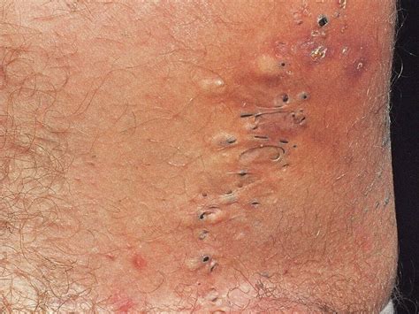 Nevus Comedonicus