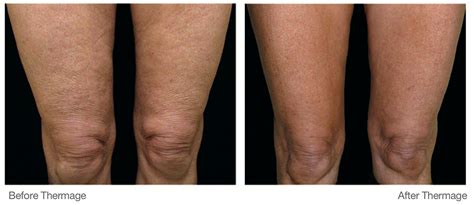 Leg Thigh Gap Before And After At Emma Spyer Blog