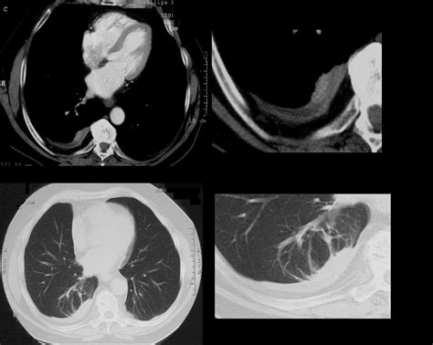 000 Atelectasis Cicatrisation Cicatricial The Common Vein