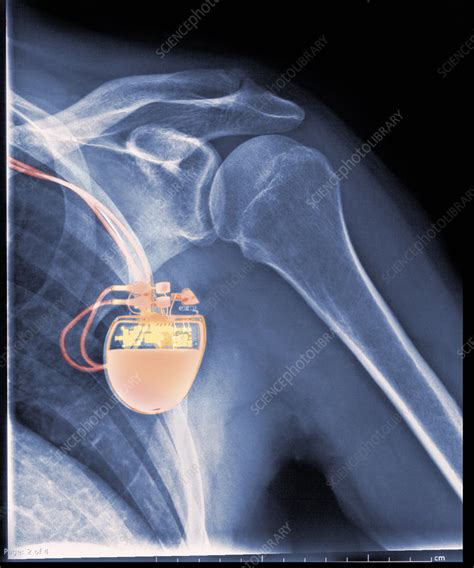 Implantable Defibrillator Pacemaker Stock Image C004 7522 Science Photo Library