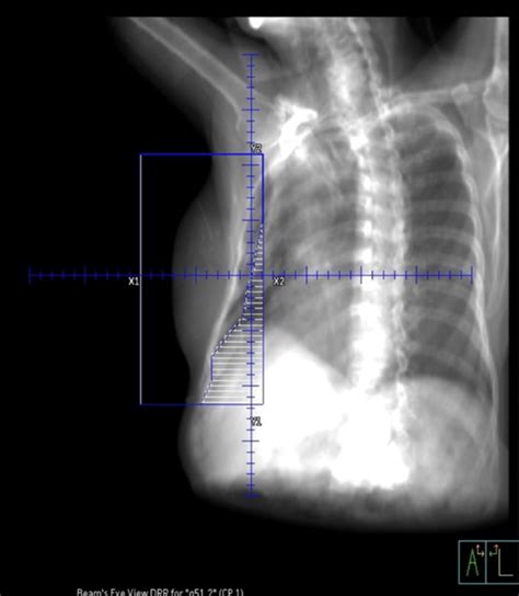Overview Breast Localization And Treatment Procedures In Radiation Therapy