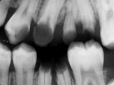 Radiographic Caries Diagnosis Pdf Dental Health Diseases And