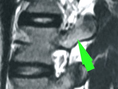 Pars Defect In Active Teens A Closer Look Sport Doctor London