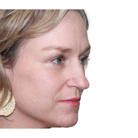 Cosmetic Functional Rhinoplasty Dr Biskup