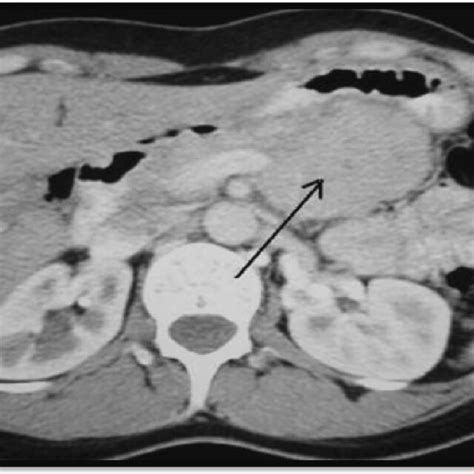Echo Endoscopy Showing Pancreatic Tumor 1 As Well As Splenic Vein 2