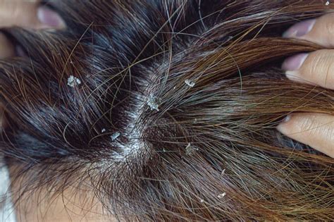 Dry Scalp Causes Treatments Tips And Faqs