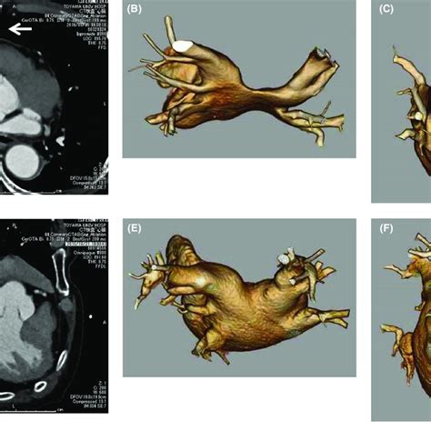 Left Lateral Decubitus Position During Catheter Ablation The Patient Download Scientific