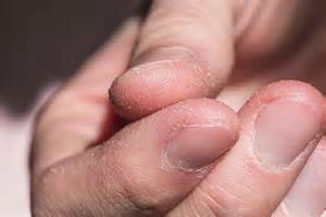 How Serious Is Skin Picking Disorder