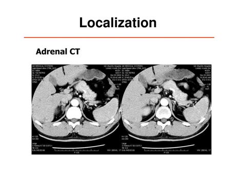 Ppt Hypercortisolism Cushing Syndrome Powerpoint Presentation Free
