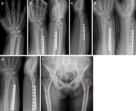 A A 62 Year Old Woman Presented With 4 Mm Positive Ulnar Variance And