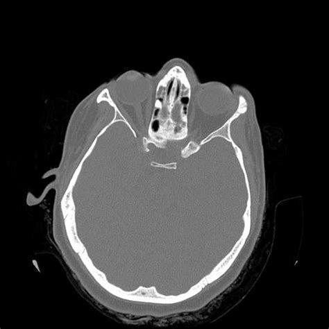 Chronic Sinusitis With Intra Sinus Calcification Radiopaedia 63919 72668 Axial Bone Window