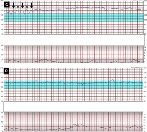 Abnormal Fetal Heart Rate Patterns Caused By Pathophysiologic Processes